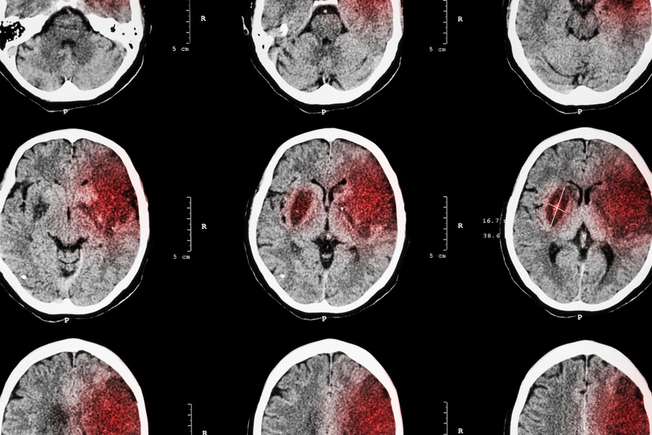Primary stroke centers: are they worth the journey? - Neuro Central